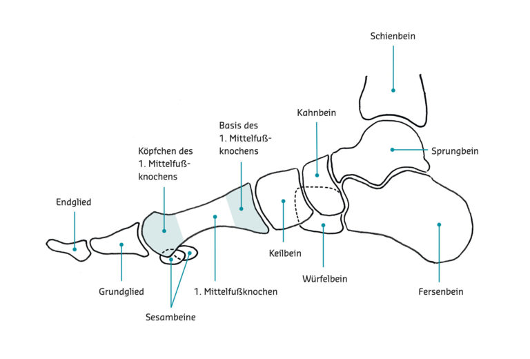Aufbau des Fußes – Hallux valgus & Co